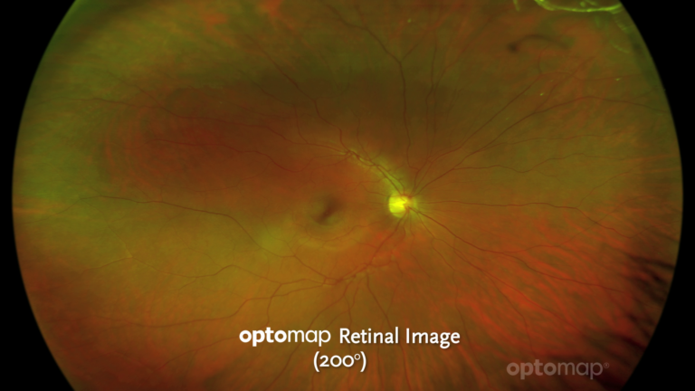 optomap Retinal Imaging - Eye Encounters